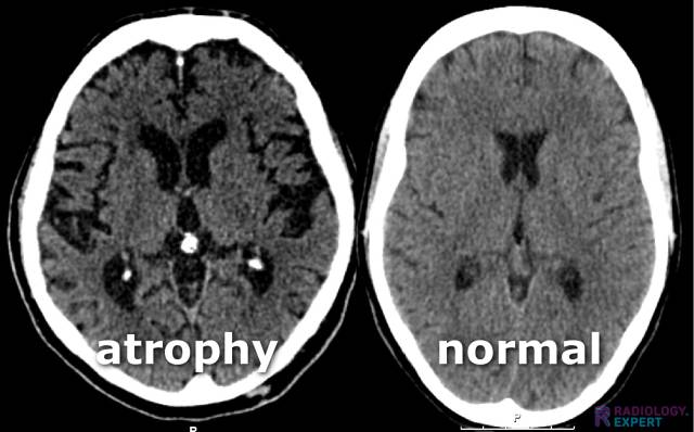 CT brain hemorrhage